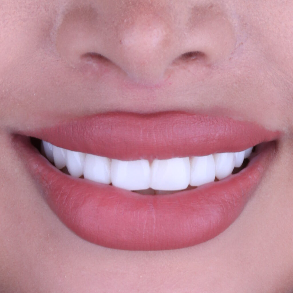 Elegance Dental Clinic – Veneers Tijuana