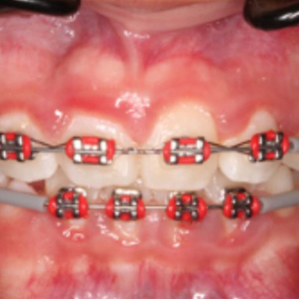 Elegance Dental Clinic – Veneers Tijuana