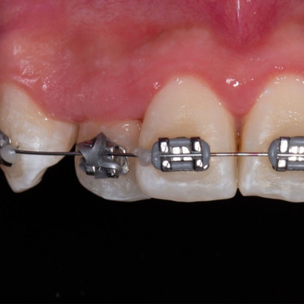 Elegance Dental Clinic – Veneers Tijuana